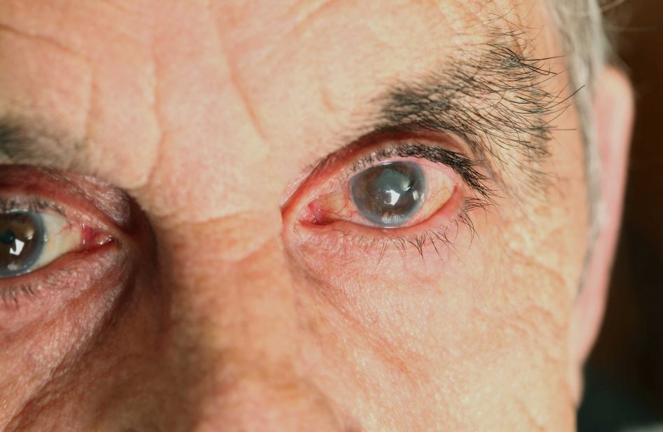 Filtration Surgery | Trabeculectomy Stockton | Glaucoma Manteca CA ... Filtration Surgery | Trabeculectomy Stockton | Glaucoma Manteca CA ...