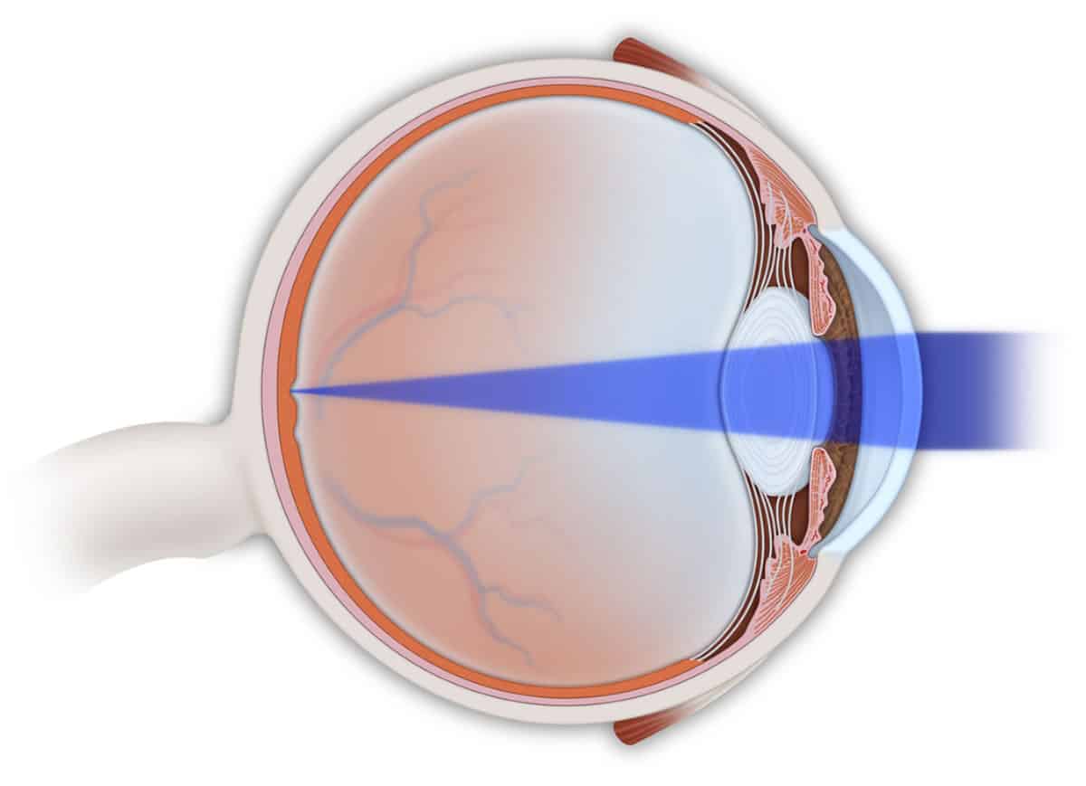 Normal Vision Central Valley Eye Medical Group