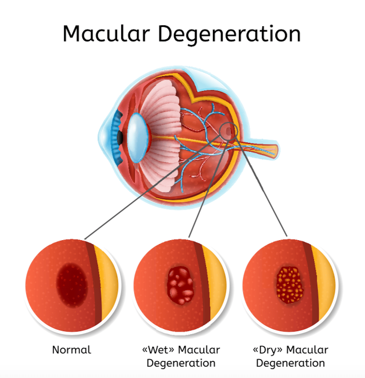 Macular Degeneration Stockton CA AMD Therapy Modesto CA